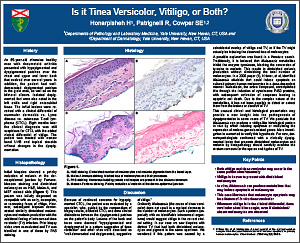 Yale Pathology Posters: 2012: Cowper: Tinea Versicolor or Vitiligo